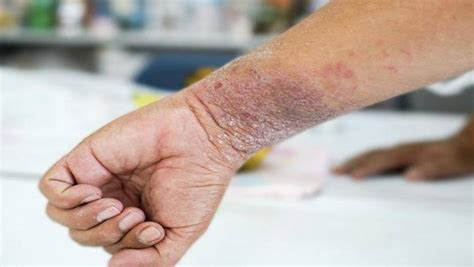 ما هو التهاب الجلد البكتيري أبو الصميق المنتشر بالسودان؟ الوطن