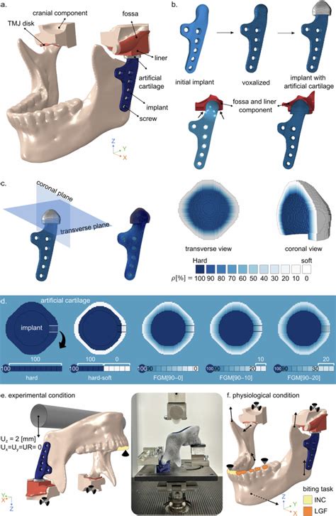 功能梯度软硬界面的多材料 3d 打印，用于增强颞下颌关节置换假体的下颌运动学communications Materials X Mol