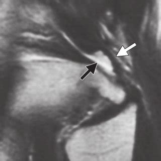 Popliteus Muscle Strain Coronal STIR Image Shows Strain Of The Download Scientific Diagram