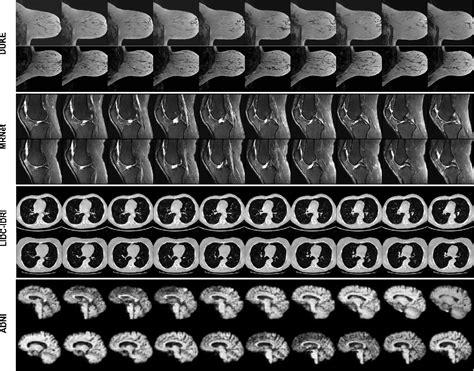 Figure From Medical Diffusion Denoising Diffusion Probabilistic Models For D Medical Image