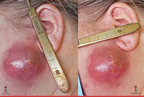 Parotid Gland Abscess Dr Noorali Bharwani