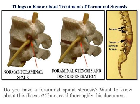 Treatment Of Foraminal Stenosis
