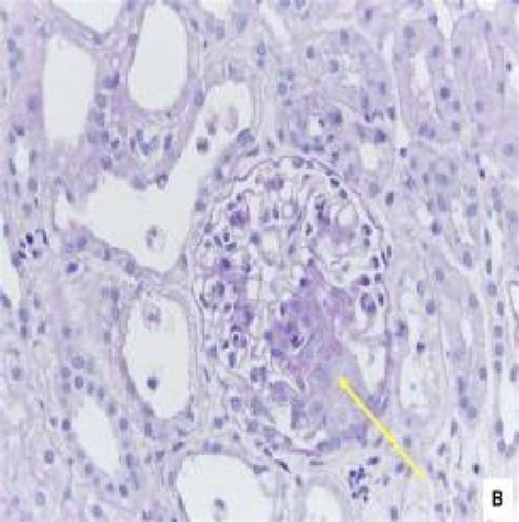 B Glomerulus With Segmental Sclerosis Yellow Arrow Periodic