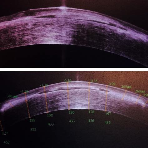 Anterior Segment Optical Coherence Tomography Scans Of Right Eye A Download Scientific