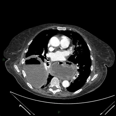 Filelung Abscess Its Drainage And Resolution Radiopaedia 82375