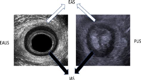 Figure 1 From Combined 3d Endoanal Ultrasound And Transperineal Ultrasound Improves The