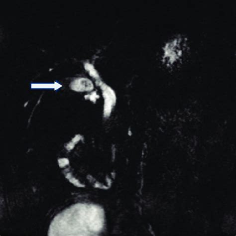 Cystic Stump Remnant In A Pregnant 33 Year Old Woman With Download Scientific Diagram