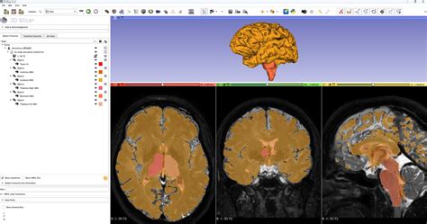 Unable To Import Brainlab Seg To Slicer Support 3d Slicer Community
