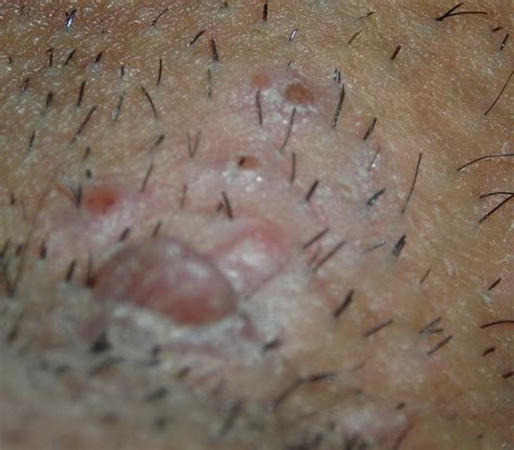 Vaginal Skin Tags Vs Genital Warts