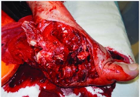 Mangled Human Body