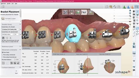 3shape Ortho System Full With Dongle Emulator