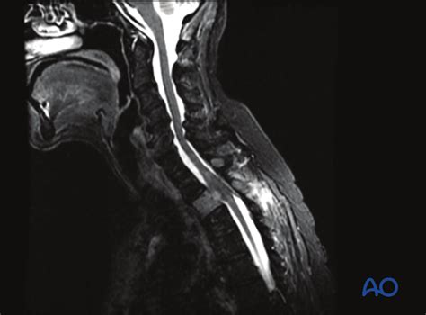 Spinal Cord Compression Scale