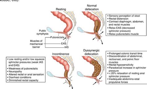 Figure 1 From Surgical Options For Intractable Constipation Review Of