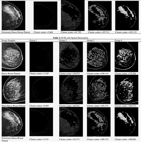 Table 2 From Mammogram Image Segmentation For Improving The Diagnosis Of Dense Breast Issues