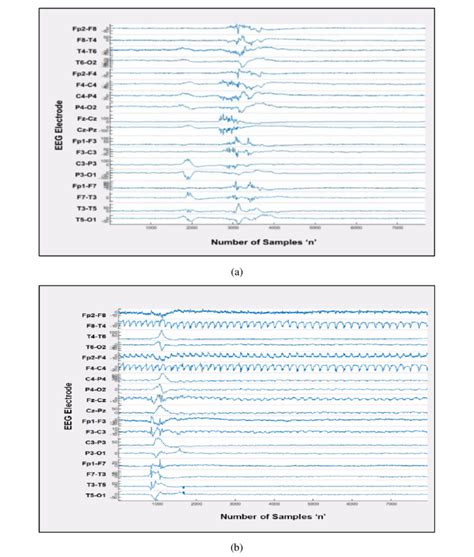A The Normal Condition EEG Signal Of Patient 1 In The Time Interval Download Scientific