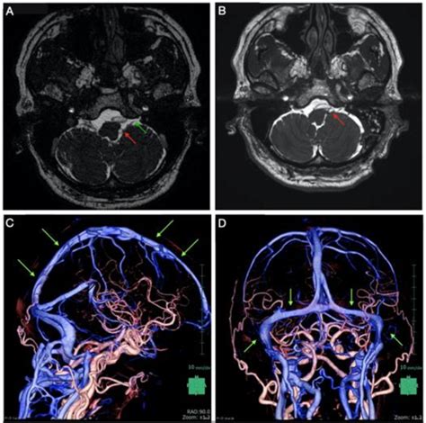 Pre Operative Radiological Image A Left Vertebral Artery Red Arrow