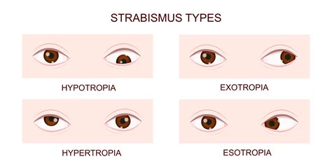 Strabismus Types Hypotropia Hypertropia Exotropia Esotropia Human Eyes With Different