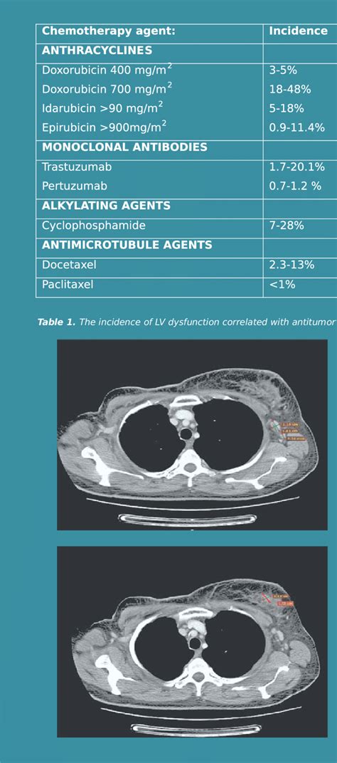 Left Axillary Lymph Nodes Download Scientific Diagram