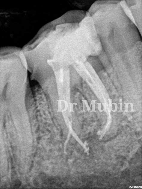 Radix Entomolaris Smiles And Roots