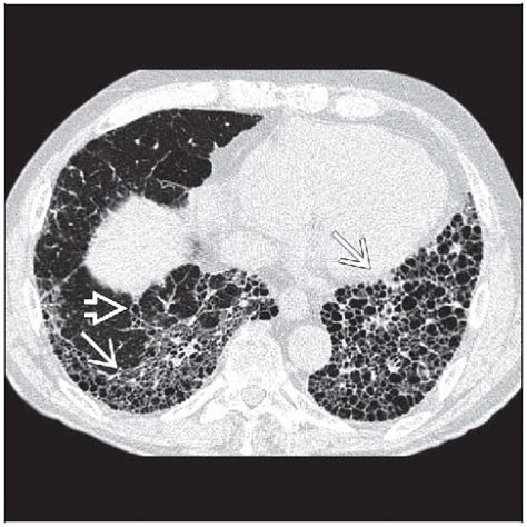 Idiopathic Pulmonary Fibrosis Chest X Ray Chest Radiology Radiology