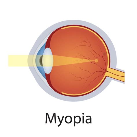 Myopia And Vision Disorders Illustration Eyes Defect Concept Detailed