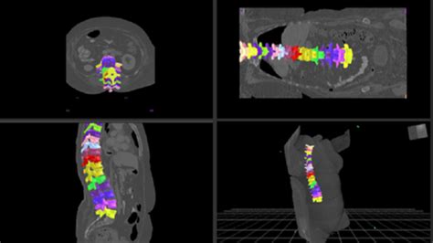Ai Powered Spinal Segmentation Technology Could ‘save Radiologists And