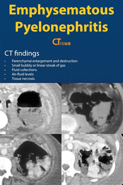 Ctisus On Linkedin Emphysematous Pyelonephritis Ct Findings