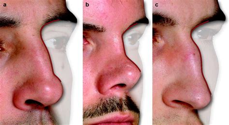Nasal Analysis Pocket Dentistry