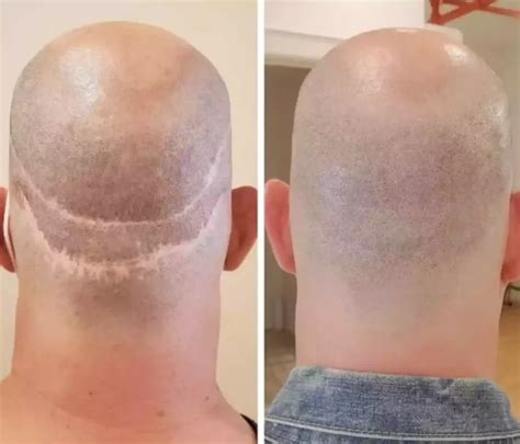 Scalp Camouflage Everything You Need To Know About Hair Tattoo