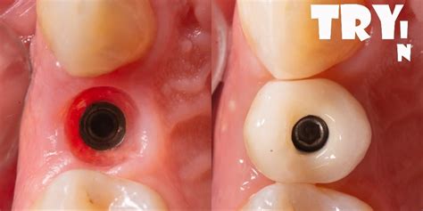 To Splint Or Not To Splint When Brain Gears Work More Than Neurotransmitters Myzerodonto