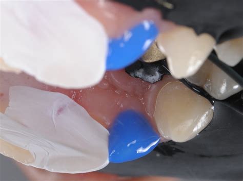 Extreme Peg Lateral Direct Restoration Styleitaliano Org