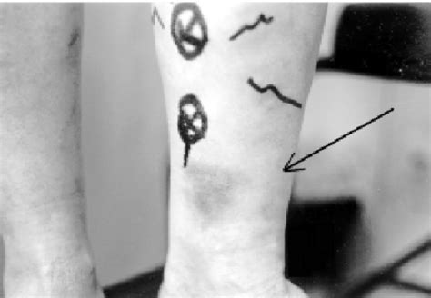 Area Of Lipodermatosclerosis Of The Left Leg Arrow The Position Of