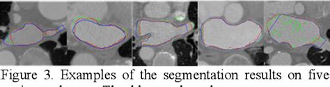 Figure 3 From A Framework For Left Atrium Segmentation On Ct Images With Combined Detection
