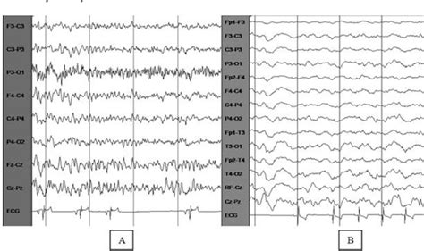 normal eeg tracing