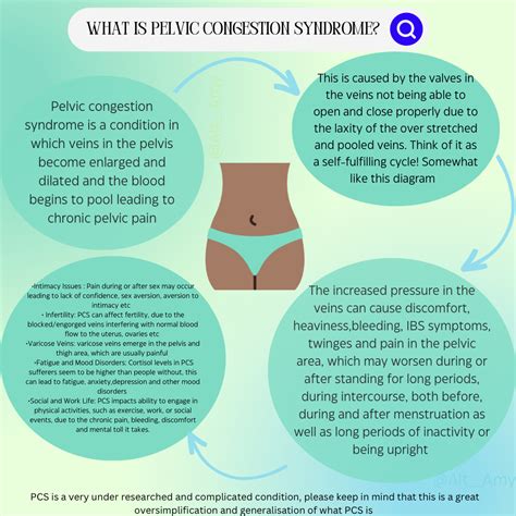 Pelvic Congestion Syndrome Artofit