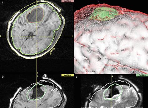 Brain Shift And Updated Intraoperative Navigation With Intraoperative Mri Radiology Key