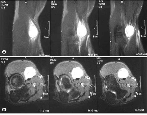 Figure 3 From A Rare Type Of Peripheral Nerve Sheath Tumor Radial