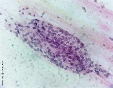 Microscopic View Of Trichomonas Vaginalis In Pap Smear With Few Acute
