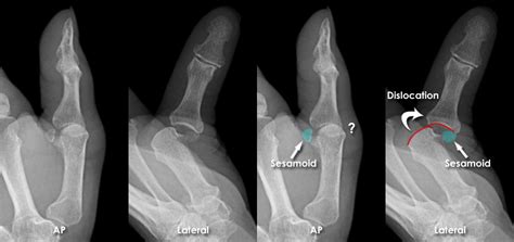 Dislocated Finger X Ray