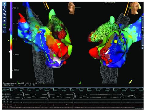Three Dimensional Electroanatomical Mapping Of A Patient With Single