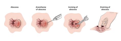 Perianal Abscess Drainage Aelius Surgical Centre