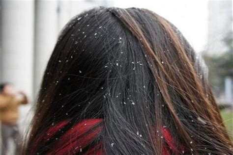 头皮屑多到像下雪？教你一招，3天彻底告别头皮屑