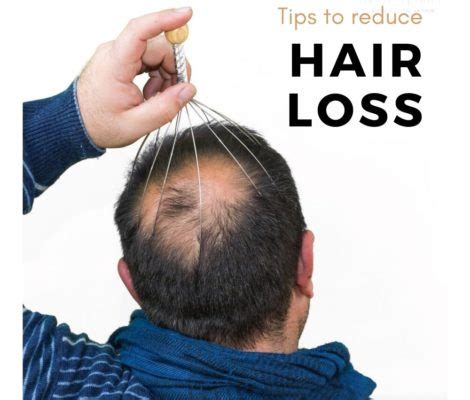 How To Prevent Balding Ask The Nurse Expert