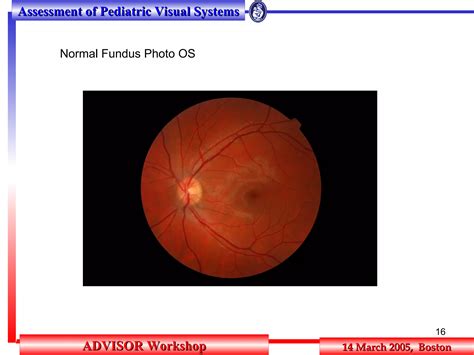 Assessment Of The Pediatric Visual System Ppt