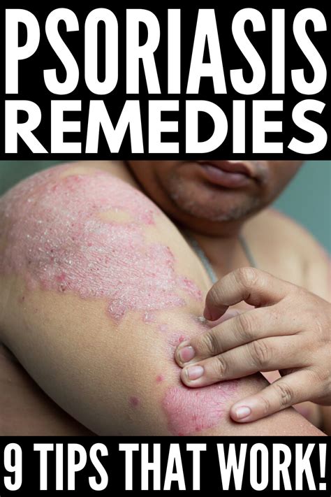 How To Control Inverse Psoriasis At Margaret Bower Blog