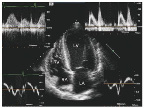 Echo In Systemic Diseases Flashcards Quizlet