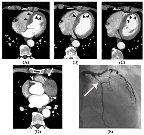 Tomography Free Full Text Diagnostic Accuracy Of Coronary Artery Occlusion And Myocardial
