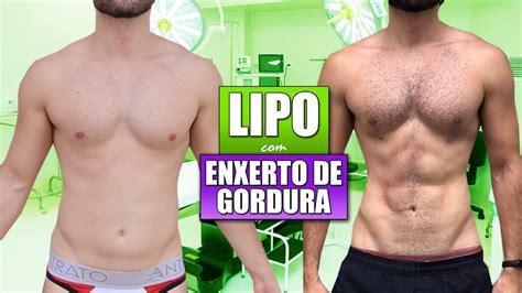 Antes E Depois Da Lipoescultura Com Enxerto No Peitoral Cirurgia