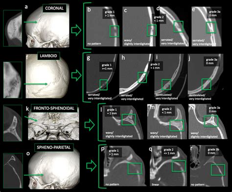 Spectrum Of Suture Patterns 3d Ct A F K O 2d Ct B C D E G Download Scientific