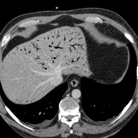 Areas Of Inflammation And Fat Stranding Surround The Sigmoid Colon Download Scientific Diagram